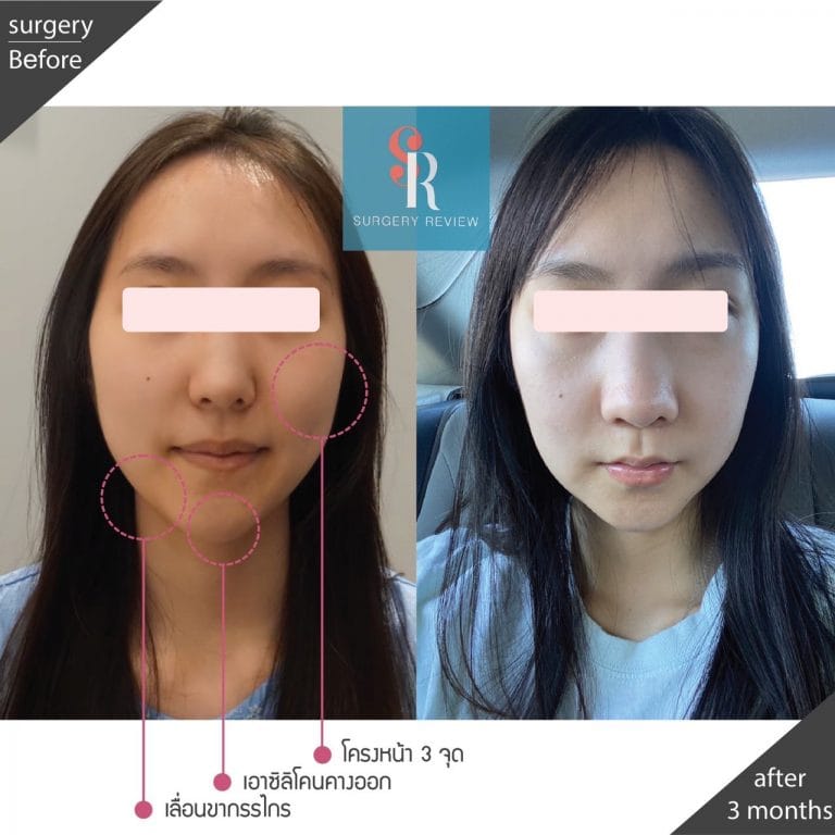 SR Surgery Review เอเจนซี่ศัลยกรรมเกาหลี ทัวร์ศัลยกรรมเกาหลี รพ. มาก ...